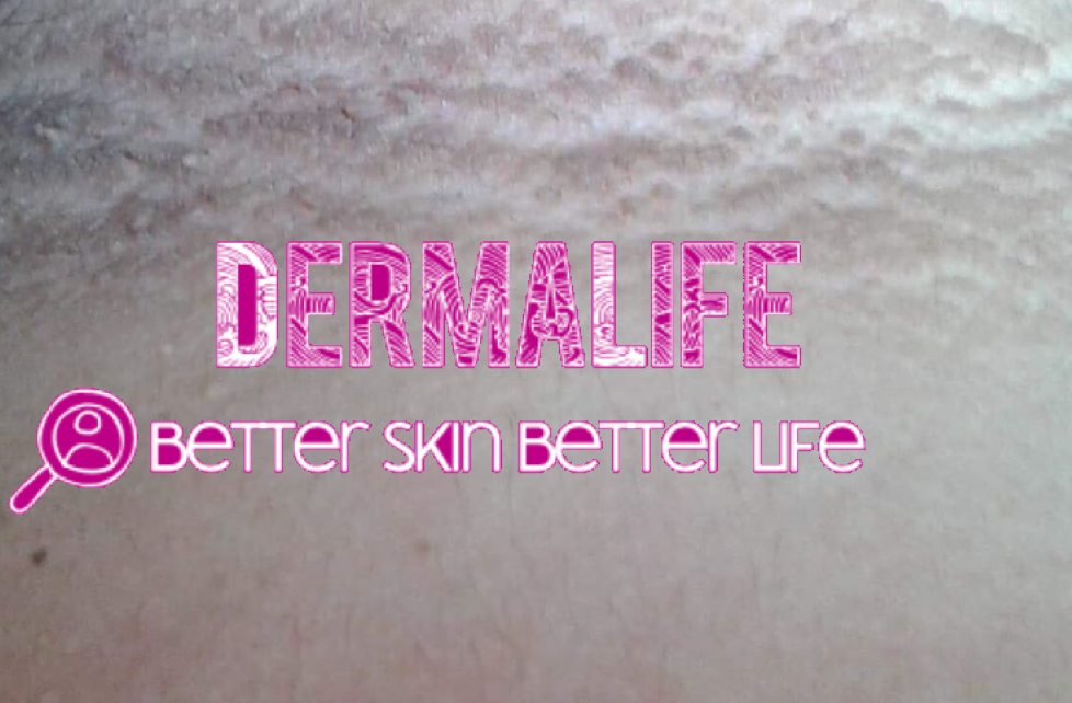 შავი აკანტოზი Acanthosis nigricans – ხათუნა კუდავა, ექიმი დერმატოლოგი ...